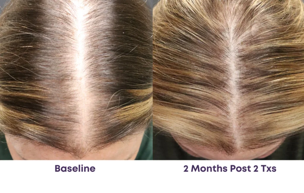 Hair Restoration - Alma TED Hair Wellness Solution