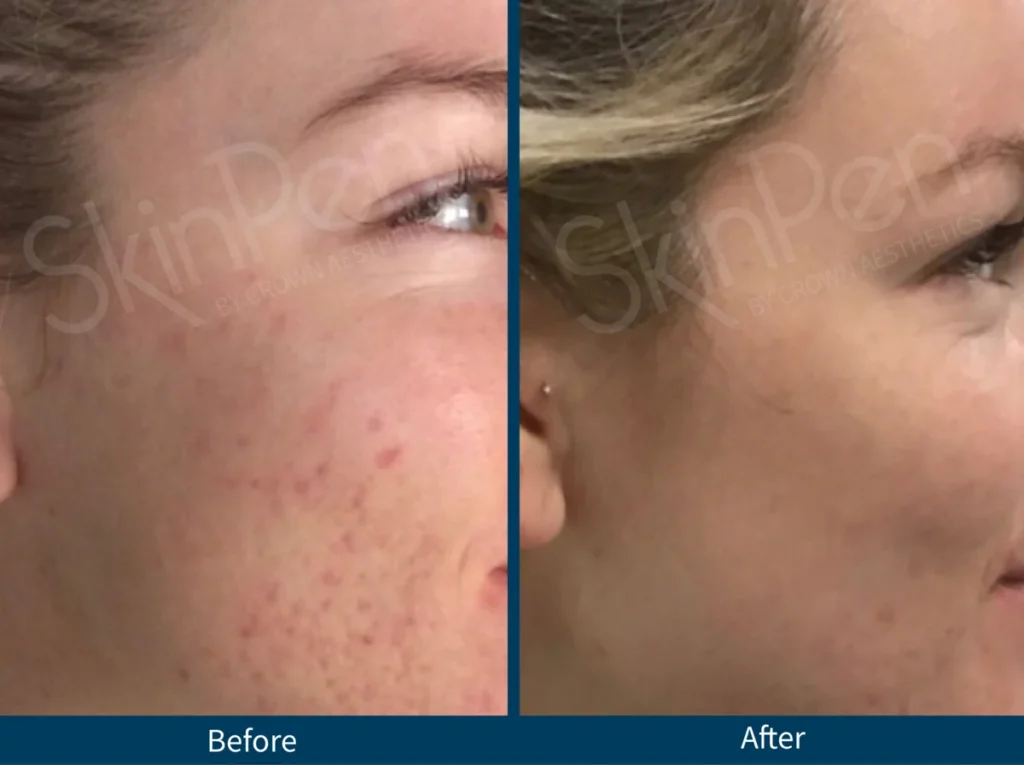 SkinPen Precision Microneedling at Dallas Laser Facial