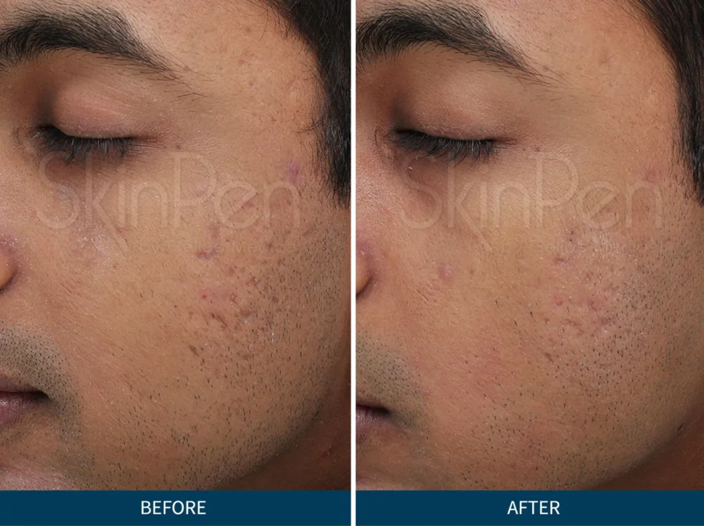 SkinPen Precision Microneedling at Dallas Laser Facial