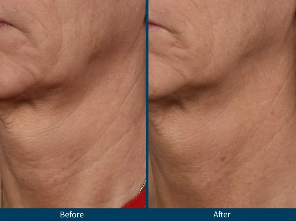 SkinPen Precision Microneedling at Dallas Laser Facial
