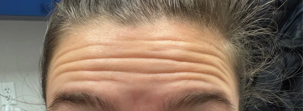 Injectables - Botox, Dysport | Dallas-The Aesthetics Project